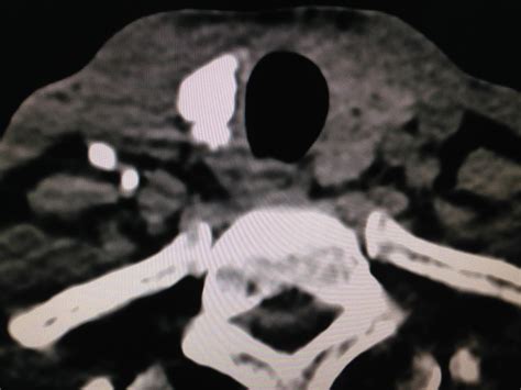 Vietnamese Medic Ultrasound Case 460 Calcified Thyroid Tumor Dr