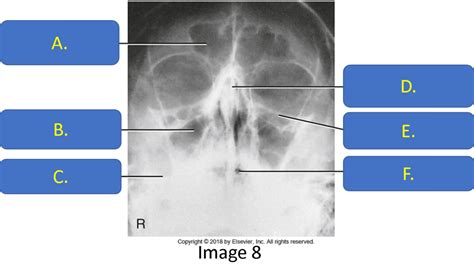 Facial Bones And Sinuses Diagram Quizlet