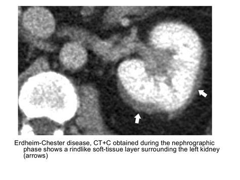 Diagnostic Imaging Of Perinephric Space