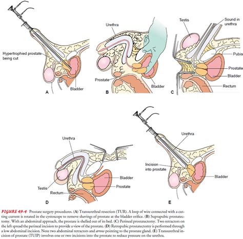 The Patient Undergoing Prostate Surgery
