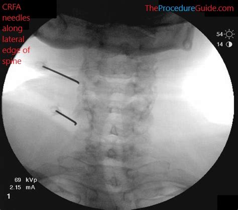 Fluoroscopic Guided Cervical Medial Branch Radiofrequency Ablation