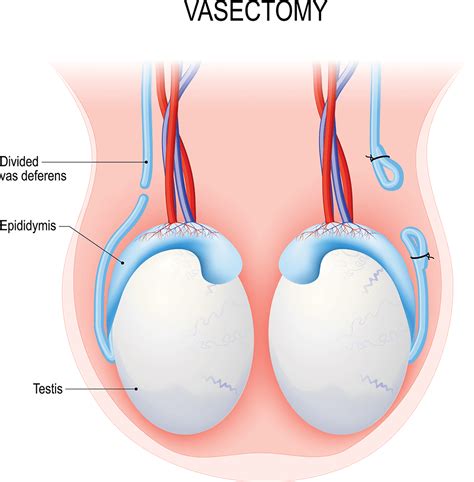 Vasectomy Procedure