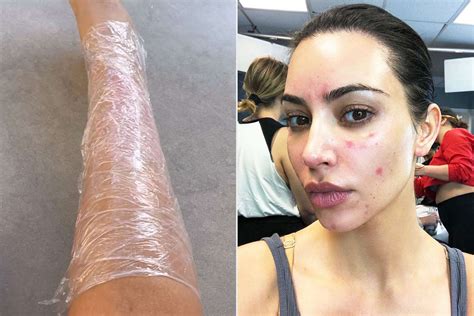 Kim Kardashian Slept In Saran Wrap For Psoriasis Relief