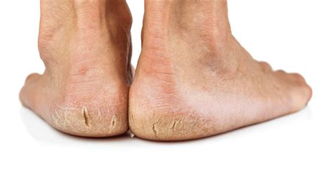Best Cure For Dry Cracked Heels Sale Online