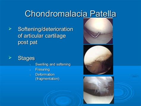 Chondromalacia Patella