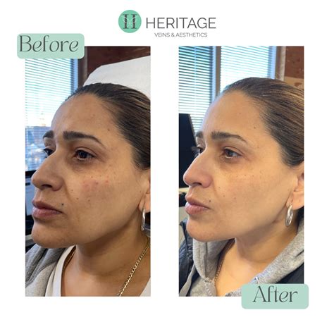 Yesenia M Radiesse® Cheek Filler Before And After Radiesse® Is A Great