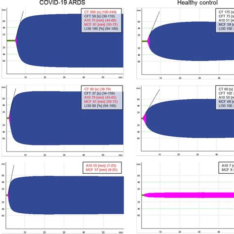 Platelet Aggregation Ability By Multiplate® Correlation Between ∆a10