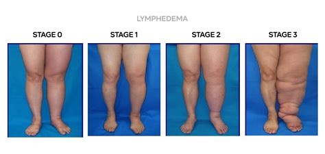 Lymphedema Staging Sun Scientific