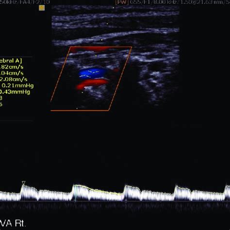 Carotid Doppler Report Download Table