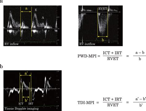 Measurement Of Pwd Mpi And Tdi Mpi The Pulsed Wave Doppler Pwd A
