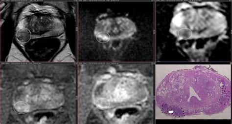 66 Year Old Patient With A Psa Of 97 Ngdl Biopsy Revealed Gleason