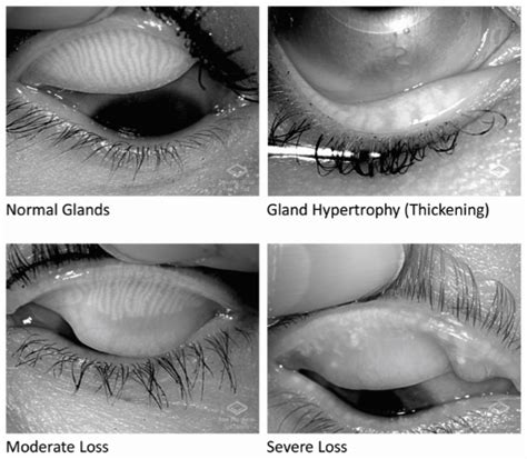 Normal Meibomian Gland