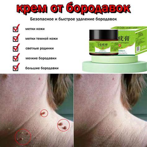 Крем для удаления бородавок 20 г Крем гель для удаления бородавок и папиллом сухих мозолей и