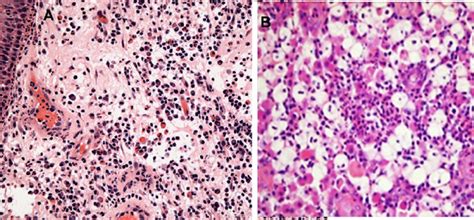 Histological Features Of A A Case Of Chronic Inflammation Showing Download Scientific Diagram