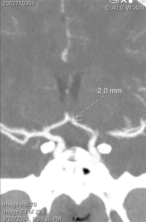Say Hello To My Brain Aneurysm 😂 Rbrainaneurysm