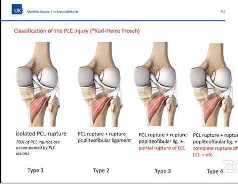 Posterolateral Corner Injuries Of Knee Tips And Tricks —