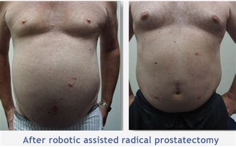 Robotic Prostate Cancer Surgery Sydney Prostate Cancer Treatment Sydney