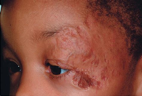 Infantile Hemangiomas Vascular Malformations And Other Vascular