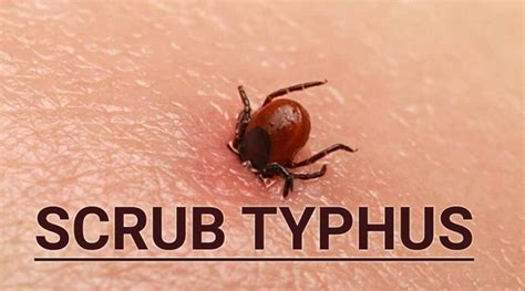 Scrub Typhus Tally Goes Up To 292 With 20 Fresh Cases In Sundargarh
