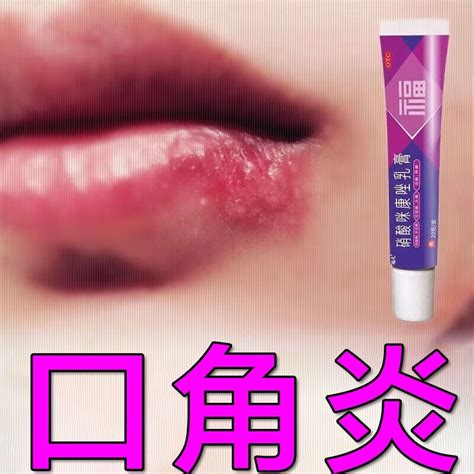 Angular Stomatitis Ointment Miconazole Nitrate Emulsifiable Paste Mouth