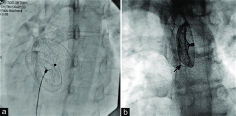 A Fluoroscopic View Of Asd Occluder Amplatzer Device Placed