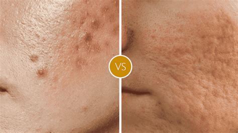 Acne Marks Vs Scars Know The Difference La Story