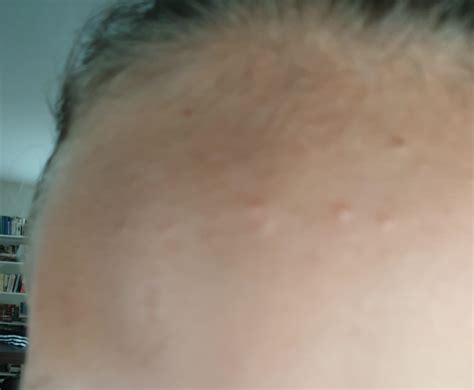 How To Get Rid Of Forehead Bumps Rskincareaddicts