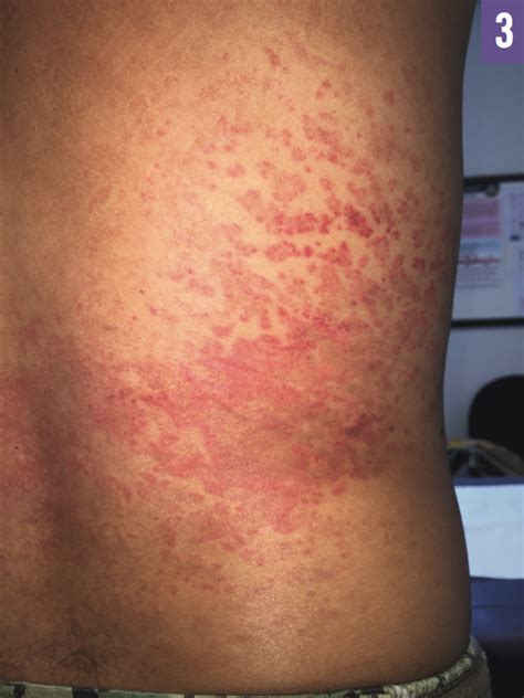 Chronic Urticaria Associated With Helicobacter Pylori Infection
