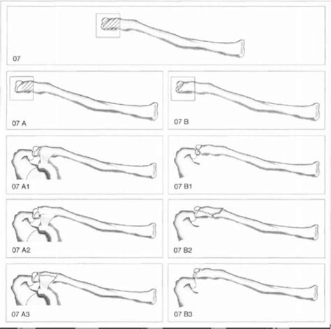 一文掌握鎖骨骨折的分類與診斷治療 壹讀