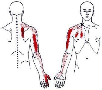 Scalenes Trigger Points