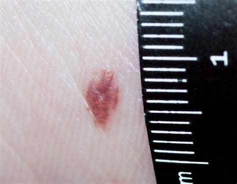 Skin Cancer Symptoms