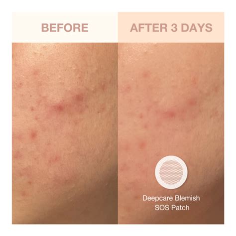 Buy Skin Inc Deepcare Blemish Sos Patch Sephora Singapore