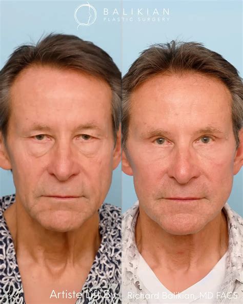 The Anatomy Behind The Deep Plane Facelift