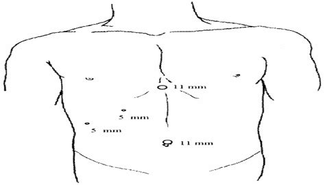 Primary Intrahepatic Lithiasis Report Of A Case Treated By