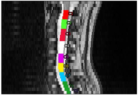 Feature Request Vertebrae Level Indication In Qc Report Sct