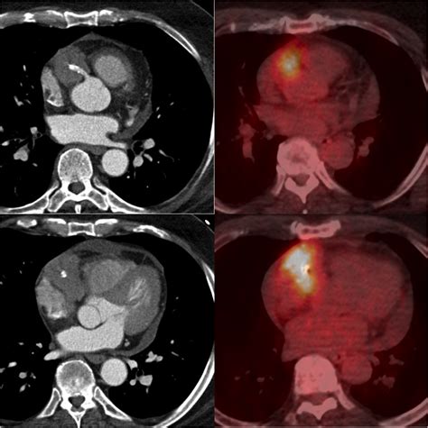 Cardiac Lymphoma