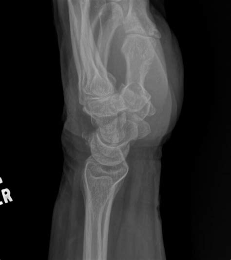 Oblique Fracture X Ray