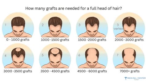 A Guide To Hair Transplant Success Rates Mct