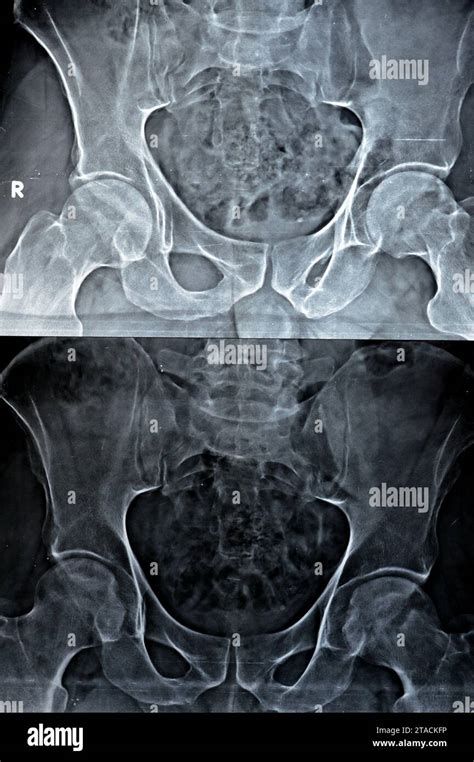 Plain X Ray Of Both Hip Joints Revealed Slight Narrowing Of Superolateral Aspect Of Both Hip