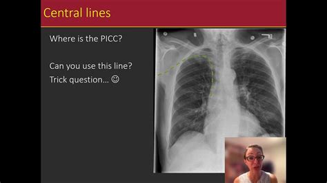 Cxr Basics With A Radiologist Tubes And Lines Youtube