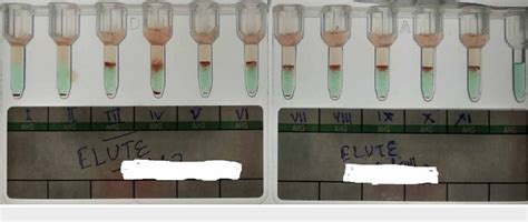 Figure 1 From An Unusual Case Of Hemolytic Disease Of Newborn Due To