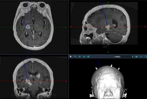 手术机器人辅助颅内病灶活检术一例（功能神经外科系列十二）——浙二神外周刊（第312期） 脑医汇