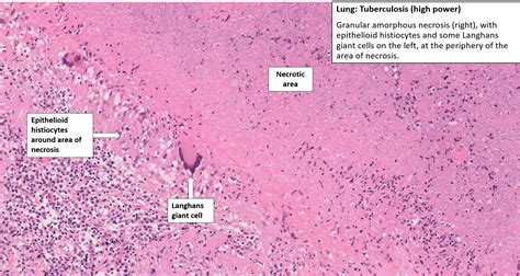 Lymph Nodes Mesenteric Tuberculosis Nus Pathweb Nus Pathweb