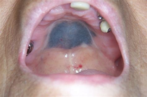 Oral Melanocytic Nevus