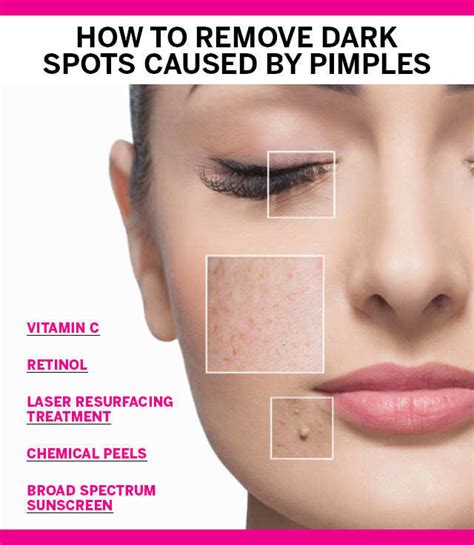 How To Get Rid Of Dark Spots On Lips Overnight