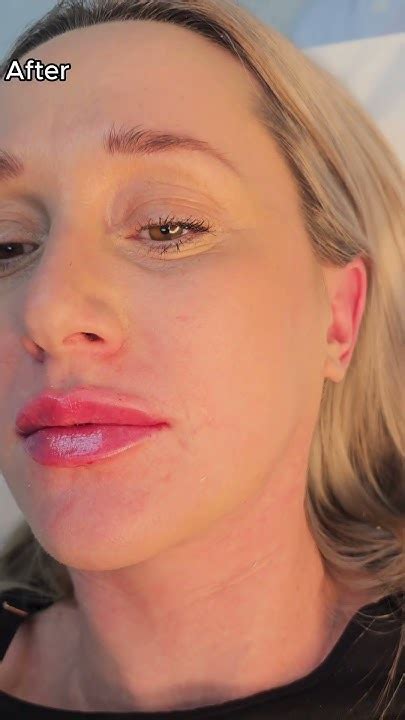 Small Tweak Big Difference Lip Filler Before And After Youtube