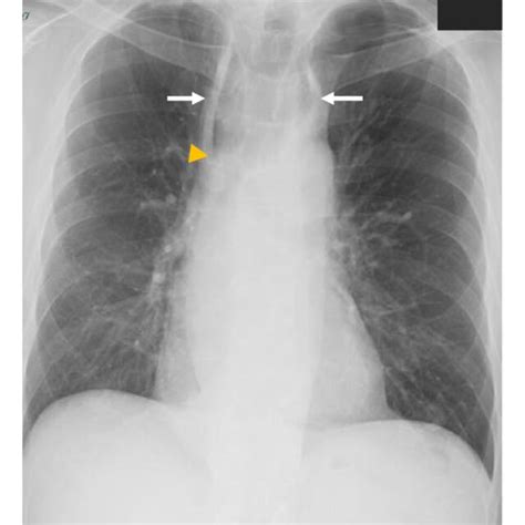Chest X Ray Demonstrated Enlargement Of The Mediastinum White Arrows