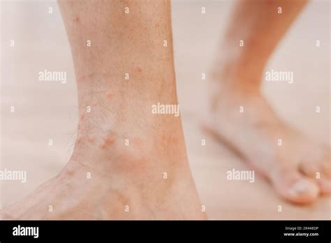 Gros Plan Dermatite Allergique éruption Cutanée Eczéma Sur Le Pied De L