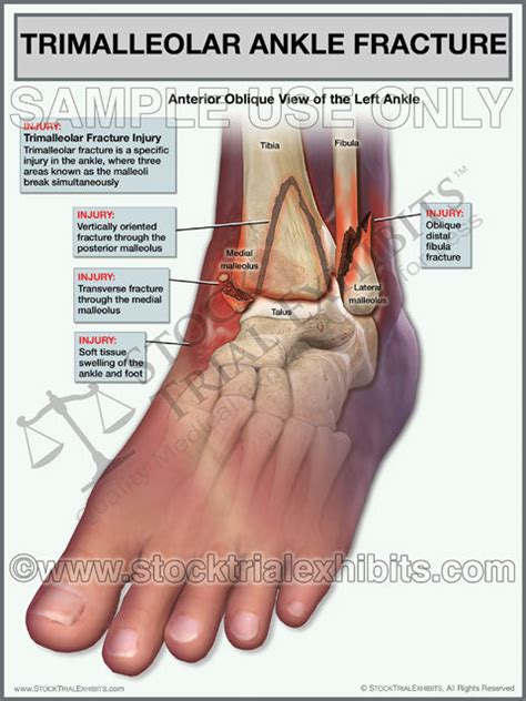 Ankle Fracture Trimalleolar Fracture Of The Left Ankle Stock Trial