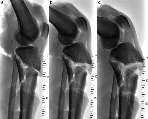 Suprapatellar Nailing Of Tibial Fractures Indications And Technique